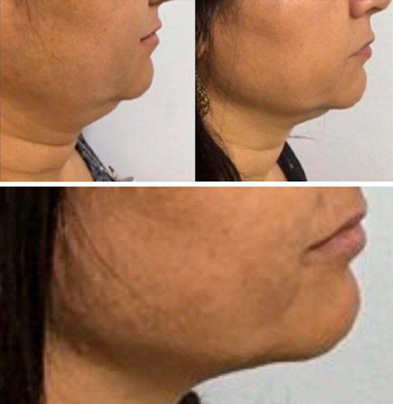 Lipo de Papada Enzimática – Shalimar Salles